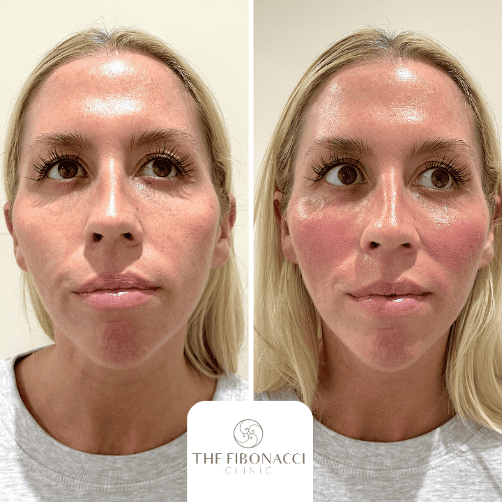 Cheek Fillers - The Fibonacci Clinic