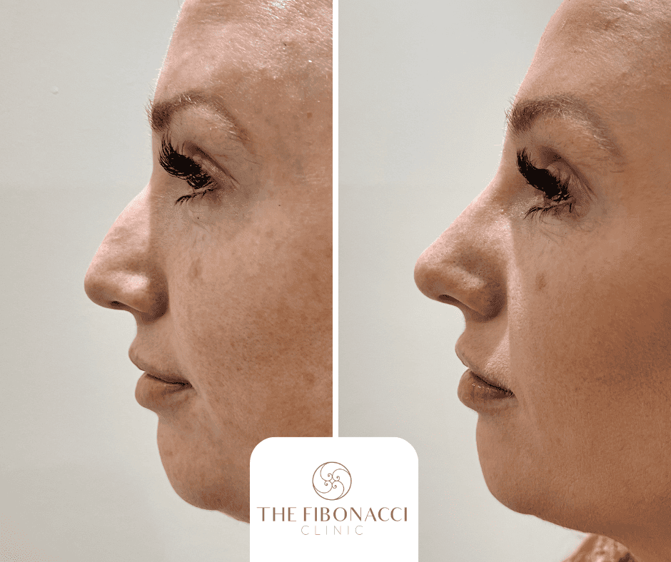 Nose Filler (Non-Surgical Nose Job/Rhinoplasty) - The Fibonacci Clinic